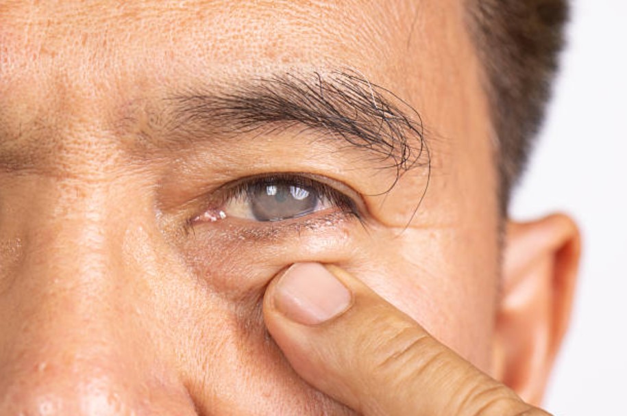 Lens Replacement Surgery Recovery: When Do Halos Go Away?